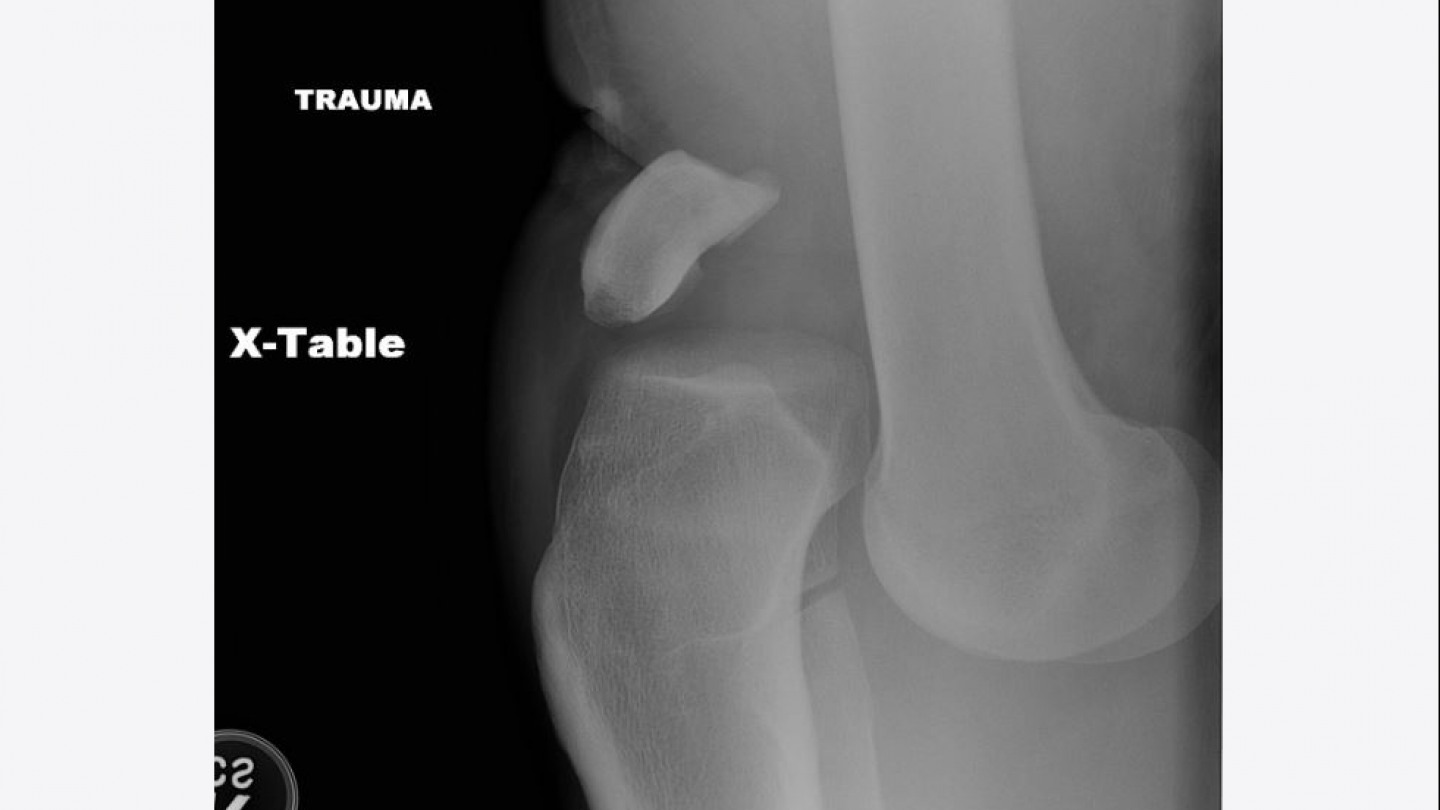 Knee Patellar Dislocation X Ray